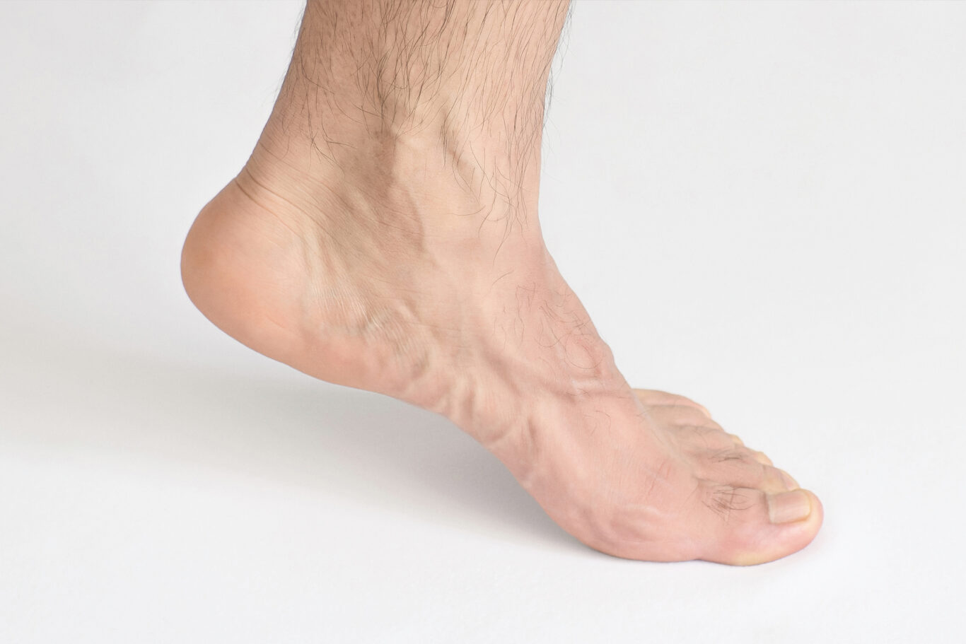 Heel Spurs | HelloPhysio