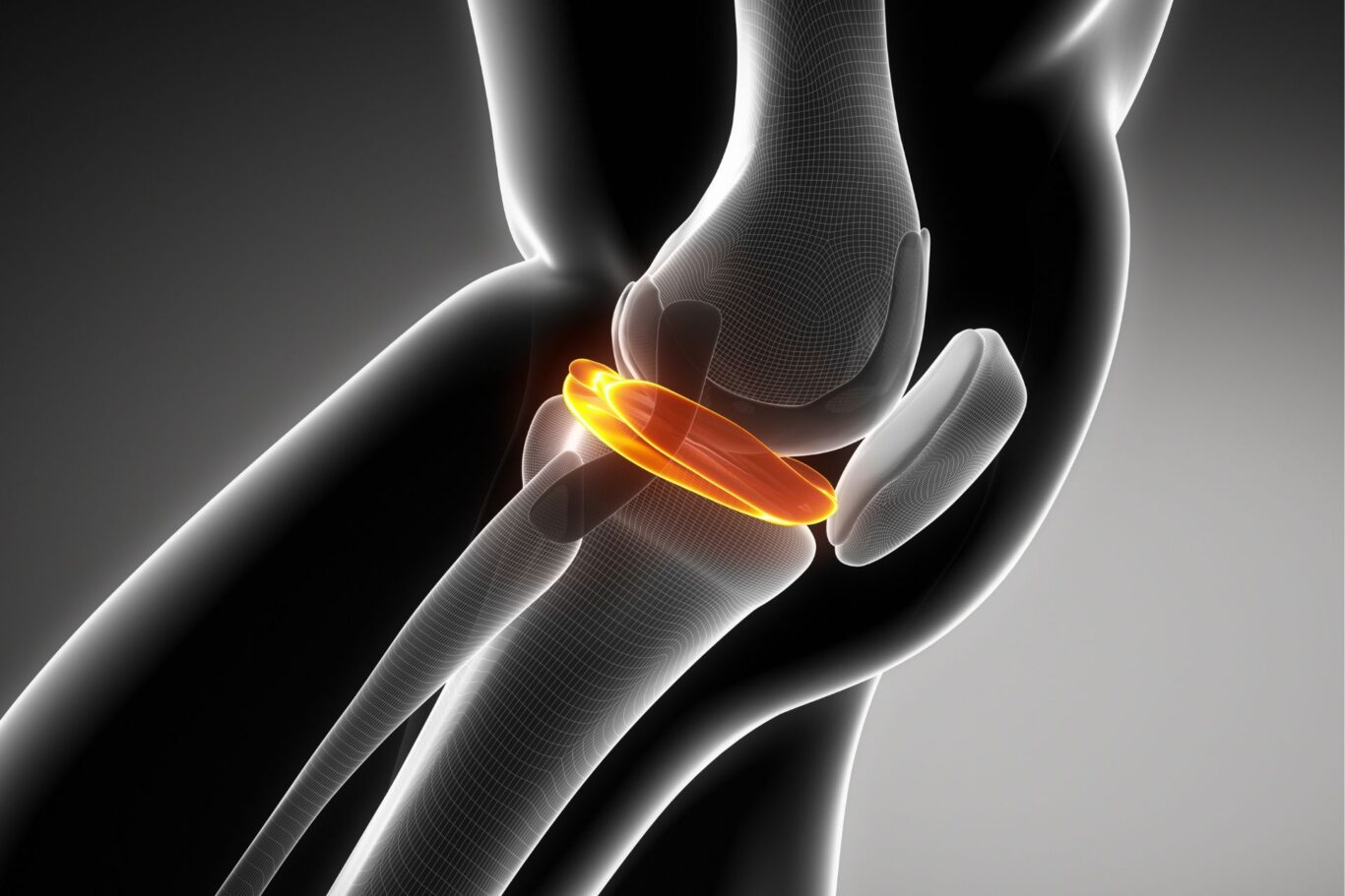Physiotherapy Treatment for Meniscus Tear Recovery