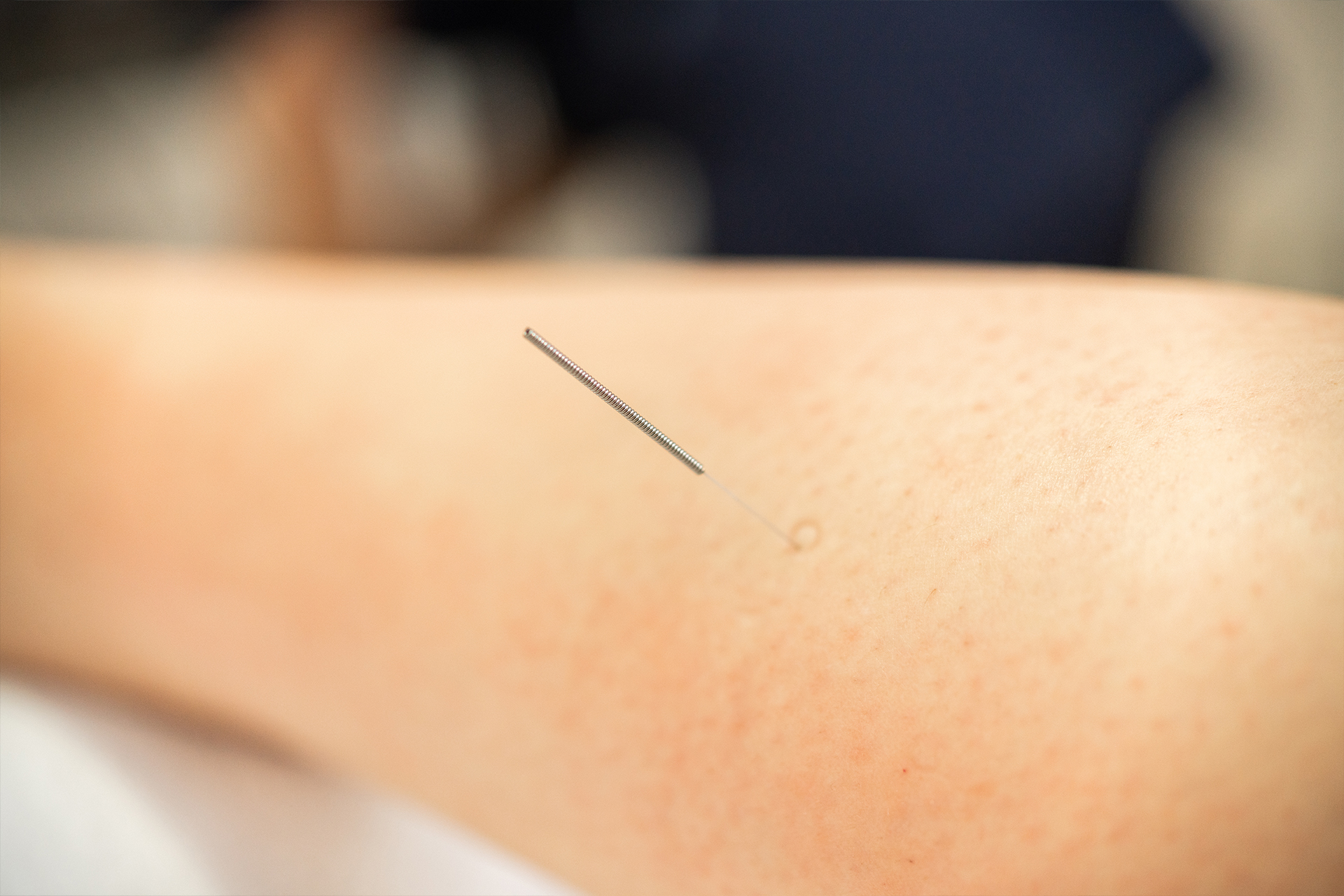 What is Dry Needling Therapy? Singapore Dry Needling Benefits