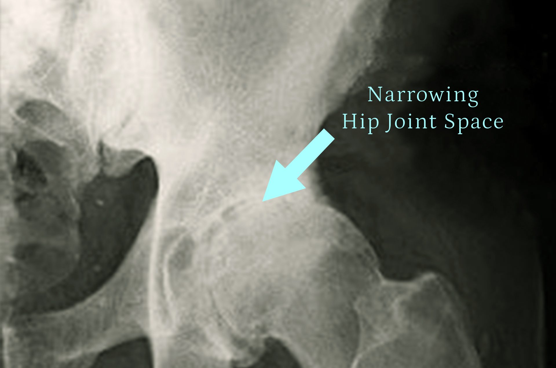 Signs You May Need Hip Replacement Surgery | Physiotherapy Tips